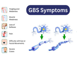 Guillain-Barre Syndrome - Symptoms and Causes